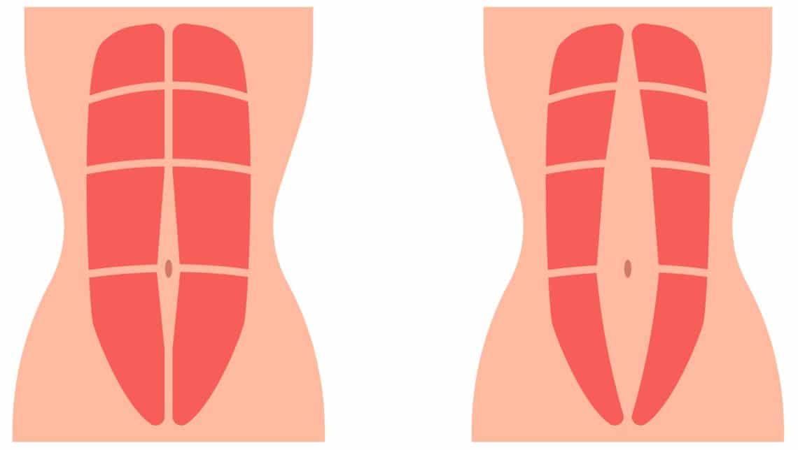 15 Best Diastasis Recti Exercises for Moms to Get Their Body Back