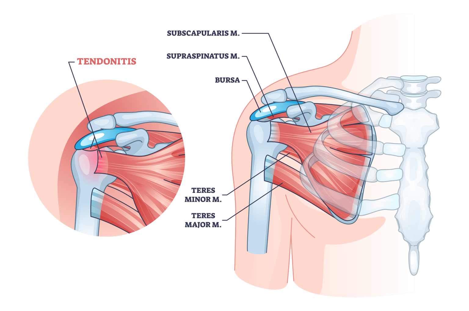 Shoulder Tendonitis: Symptoms, Causes, Treatment, and Prevention – Fitness Volt