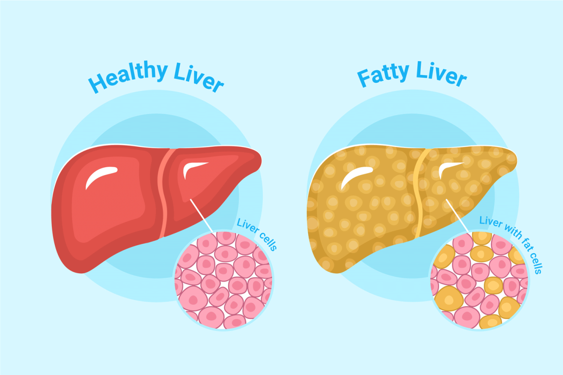 Intermittent Fasting and Liver Health: The Surprising Benefits ...