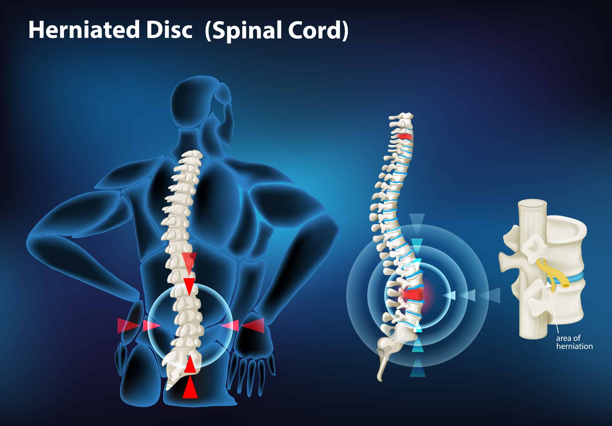 Understanding and Preventing Lower Back Pain from Squats: Insights from ...