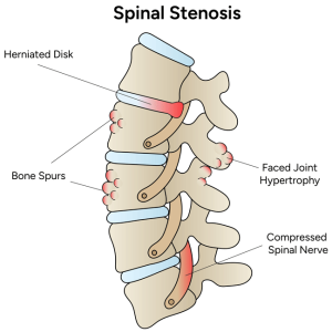 Unlocking Relief: 8 Targeted Exercises for Spinal Stenosis – Fitness Volt